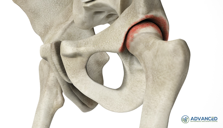 Hip Dysplasia: Causes, Symptoms & Treatments | Advanced Orthopaedics